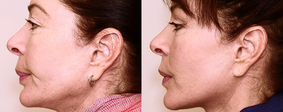 Dental Face Lift - Οδοντιατρικό Lifting αντιγήρανσης - Οδοντιατρική ...